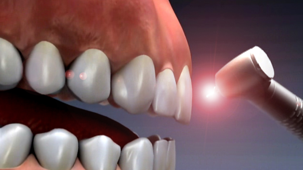 Dental Lasers: How They Help Maintain Oral Hygiene | Shervin M. Louie, DDS