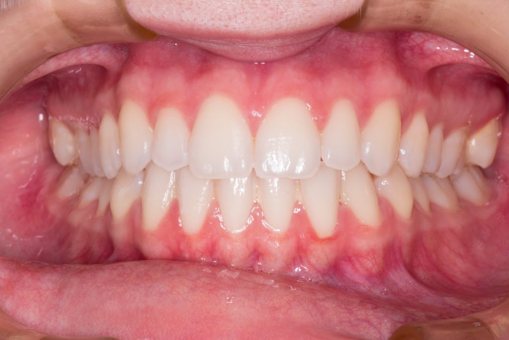 Four Different Types of Teeth and Their Function | Shervin M. Louie, DDS